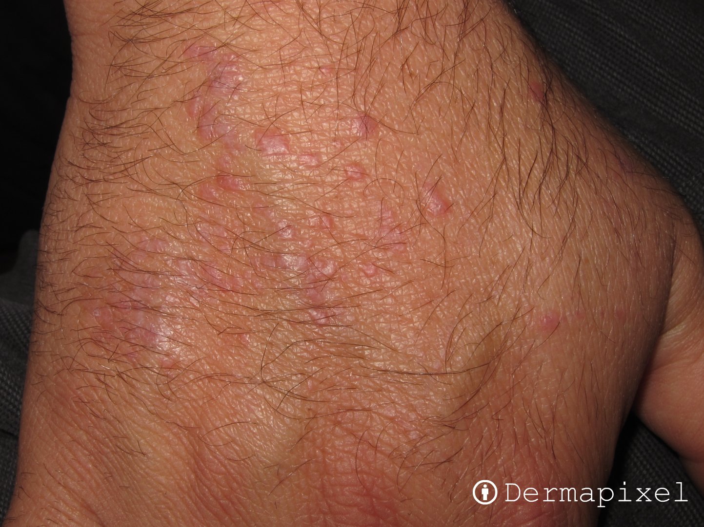 Dermapixel: junio 2011