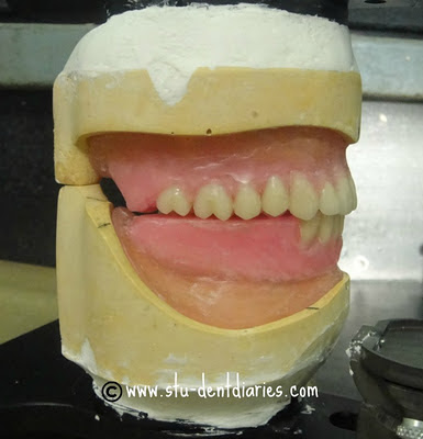 Stu-DENT Diaries: Setting Maxillary and Mandibular Posterior Teeth