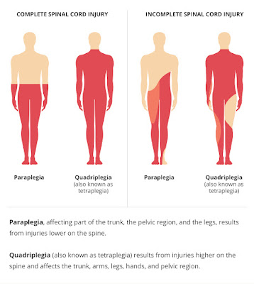 Brief Introduction to Spinal Cord Injury part 2 ~ Life of Wheelchair User