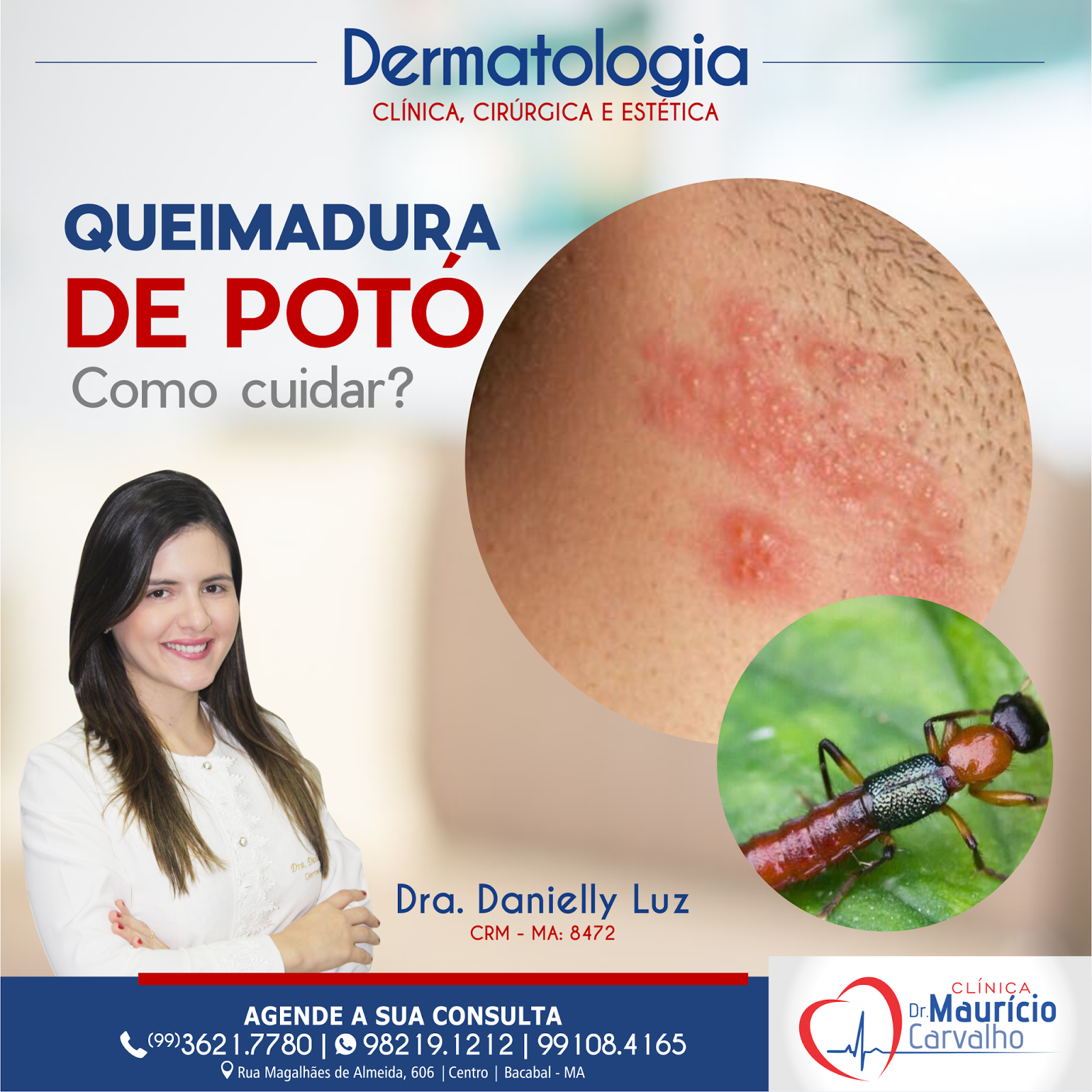 Queimadura De Potó Sintomas - RETOEDU