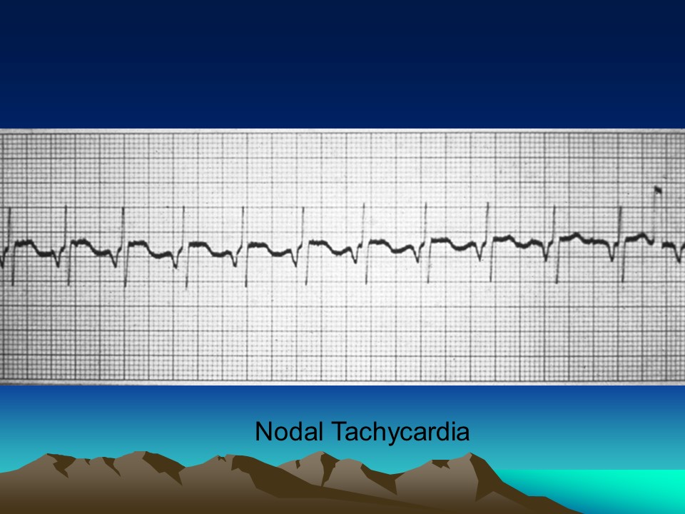 CVT Mohd Farid: Electrocardiogram ECG Part III Basic ECG Rhythm Pattern ...