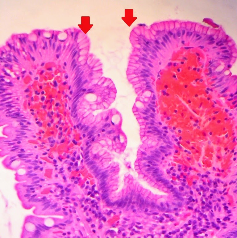 GASTROINTESTINAL AND LIVER HISTOLOGY PATHOLOGY ATLAS: DUODENUM: PEPTIC ...