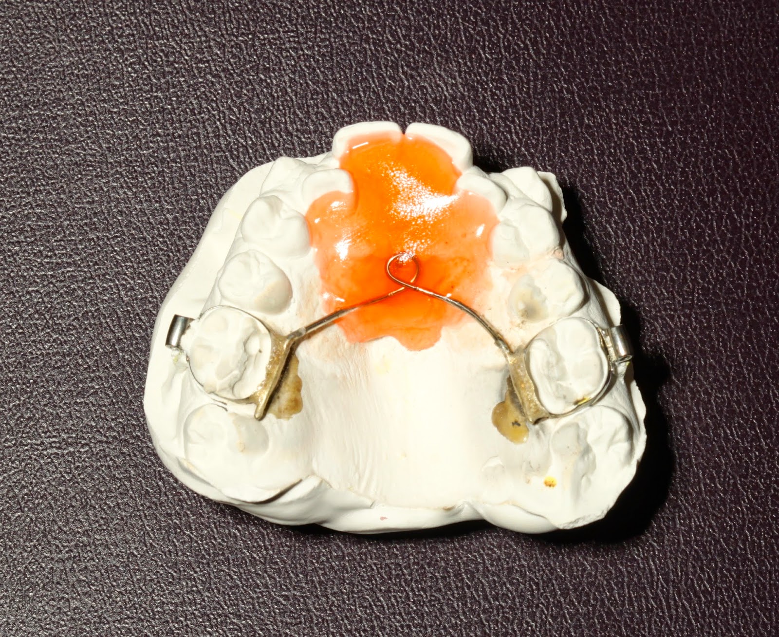 Orthodontic Thoughts: Modifying a Nance Button To Use As a Bite Plane