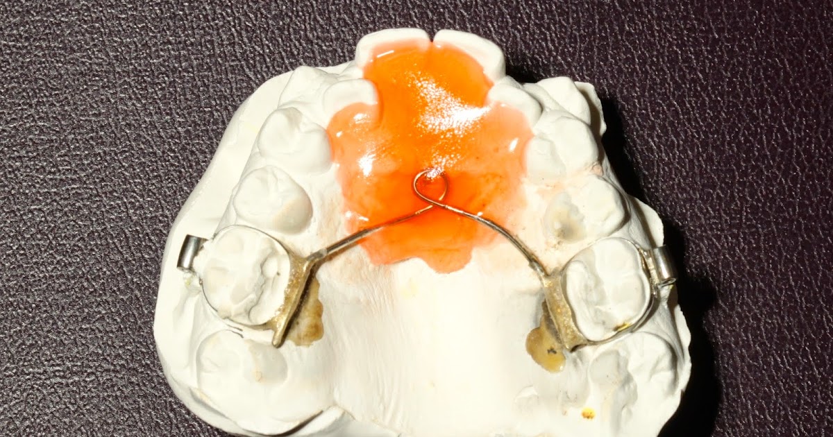 Orthodontic Thoughts: Modifying a Nance Button To Use As a Bite Plane