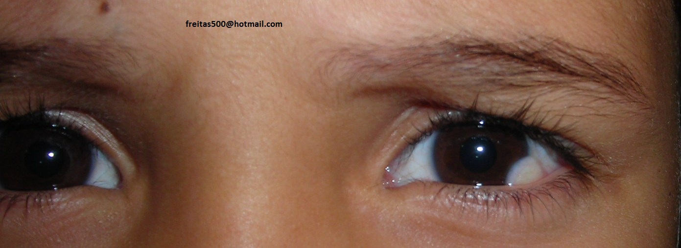 Oftalmologia Clínica & Cirúrgica: Coristoma