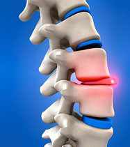 Slipped Disc in neck Symptoms, Exercises and Recovery Time