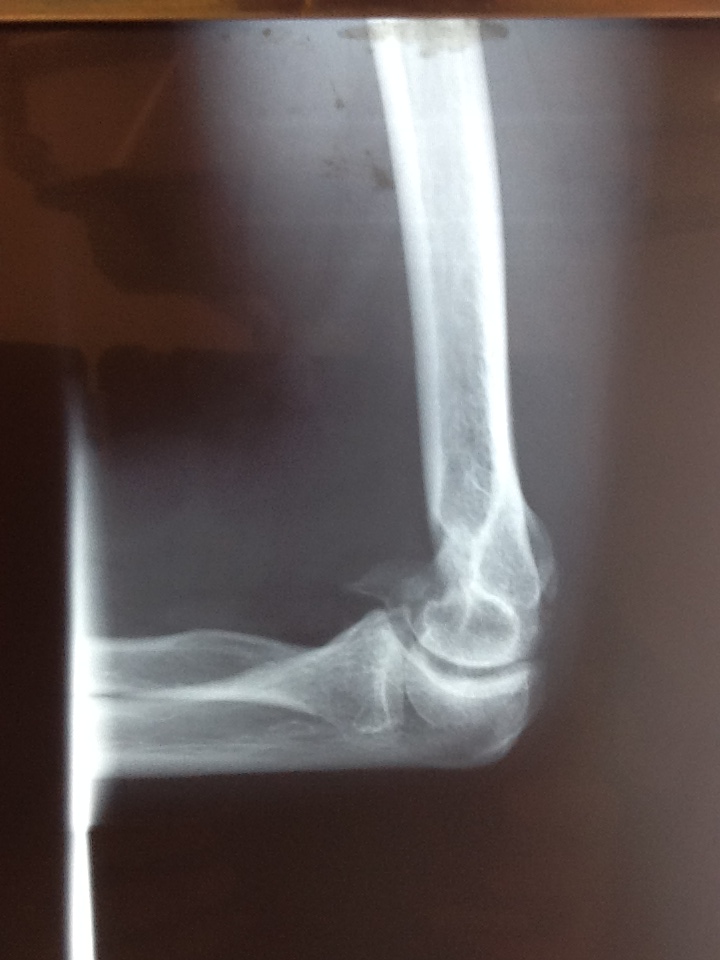 O R T O C R I T I C A: Inestabilidad Rotatoria Posterolateral de Codo ...