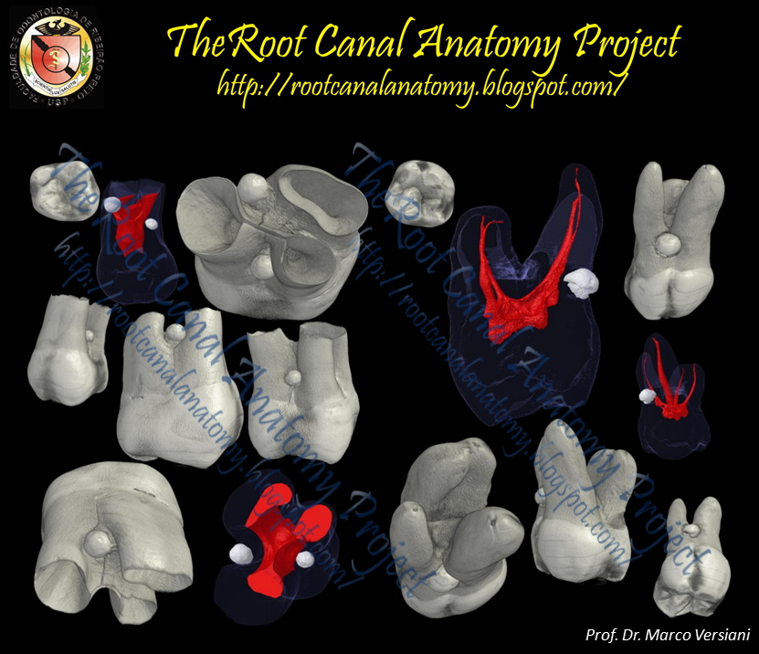 The Root Canal Anatomy Project: Enamel Pearls in Permanent Dentition