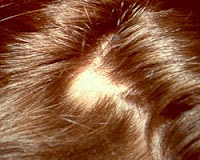Not only drugs: Patchy hair loss