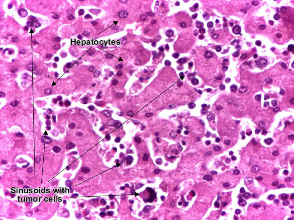 موقع الدكتور أحمد كلحى: باثولوجى Pathology Slides : Hematopathology