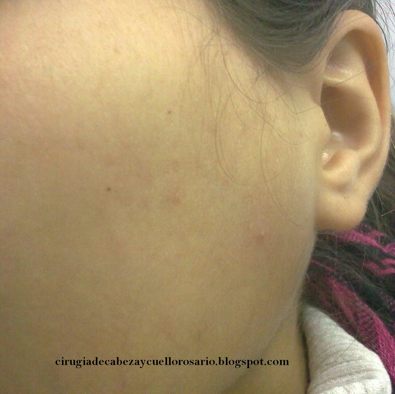 Cirugía de Cabeza y Cuello Rosario: PAROTIDITIS AGUDA