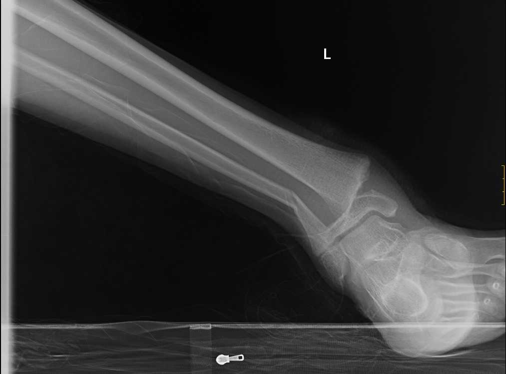 Fanáticos del pie: ATLAS DE PATOLOGÍA DEL PIE: EPIFISIOLISIS DE TIBIA ...