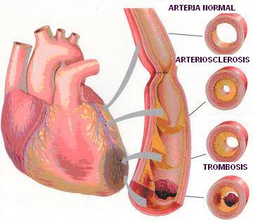 CARDIOLOGIA: SÍNDROME CORONARIO AGUDO