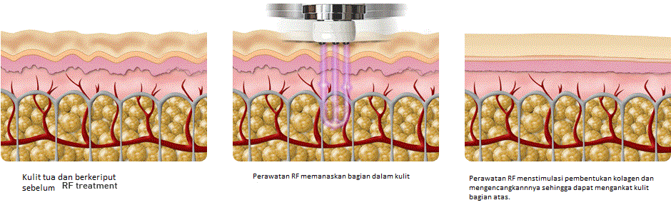 Rumah Kecantikan Samarinda: Perawatan RadioFrequency (RF)