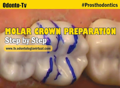 PROSTHODONTICS: Molar Crown Preparation - Step by Step - Odonto-Tv