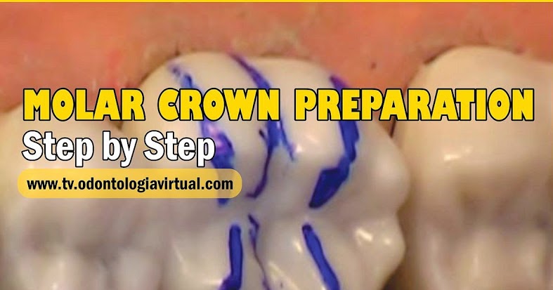 PROSTHODONTICS: Molar Crown Preparation - Step by Step - Odonto-Tv