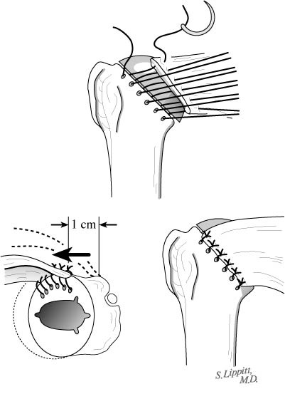 Shoulder Arthritis / Joint Replacement : Shoulder arthroplasty for ...