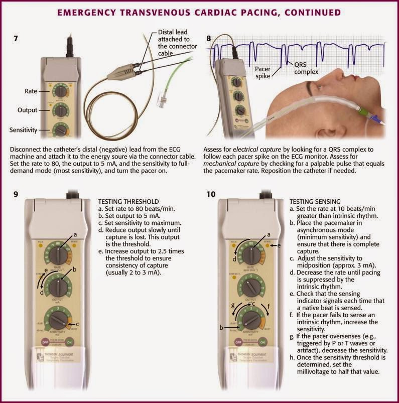 Procedures Club: Transvenous Pacing - Decoding the Box