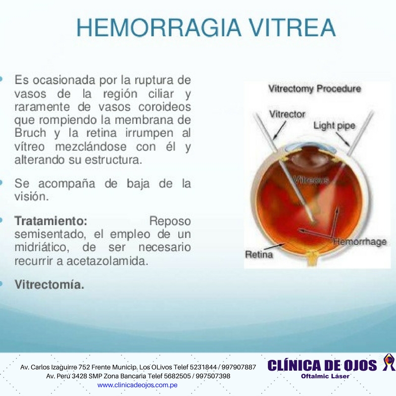 Clínica de Ojos Oftalmic Láser: Hemorragia vítrea