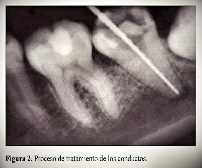 PDF: Manejo endodóntico de una inusual configuración del sistema de ...