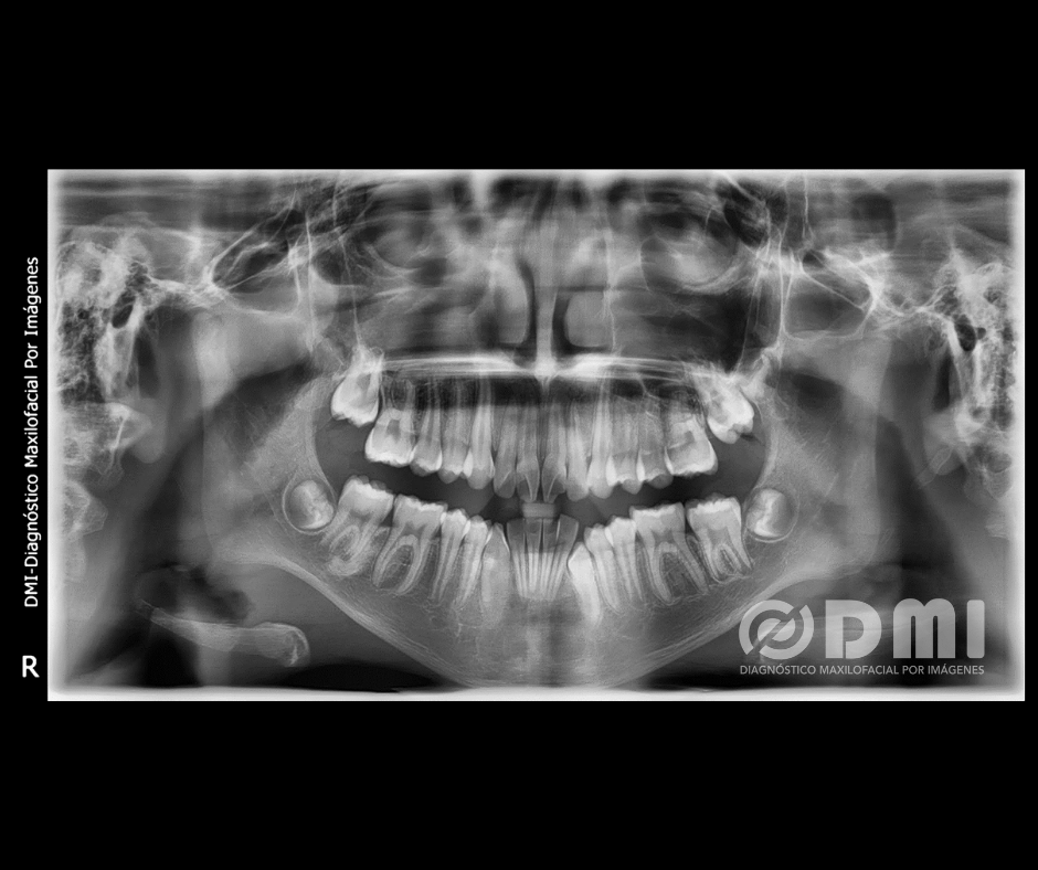 Diagnóstico Maxilofacial por Imágenes: Caso 09_ Enostosis y radix ...