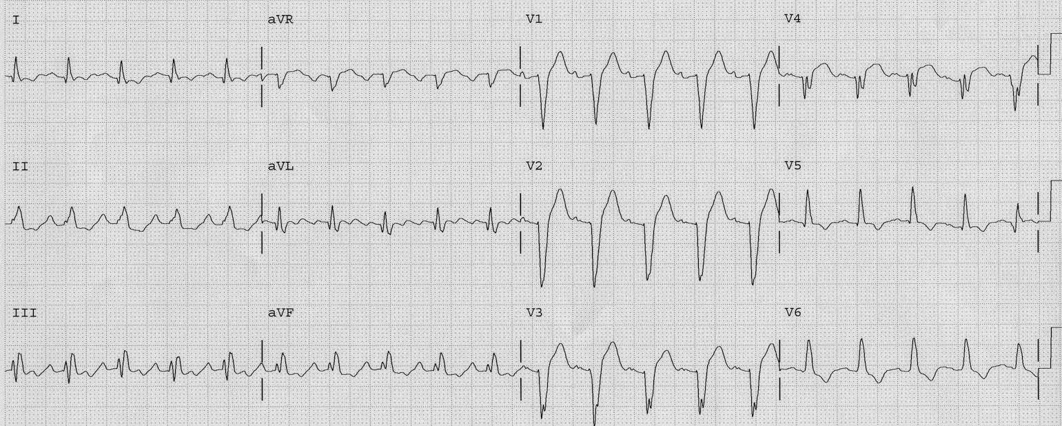 Dr. Smith's ECG Blog: LBBB: is there STEMI?