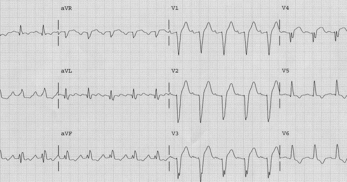 Dr. Smith's ECG Blog: LBBB: is there STEMI?