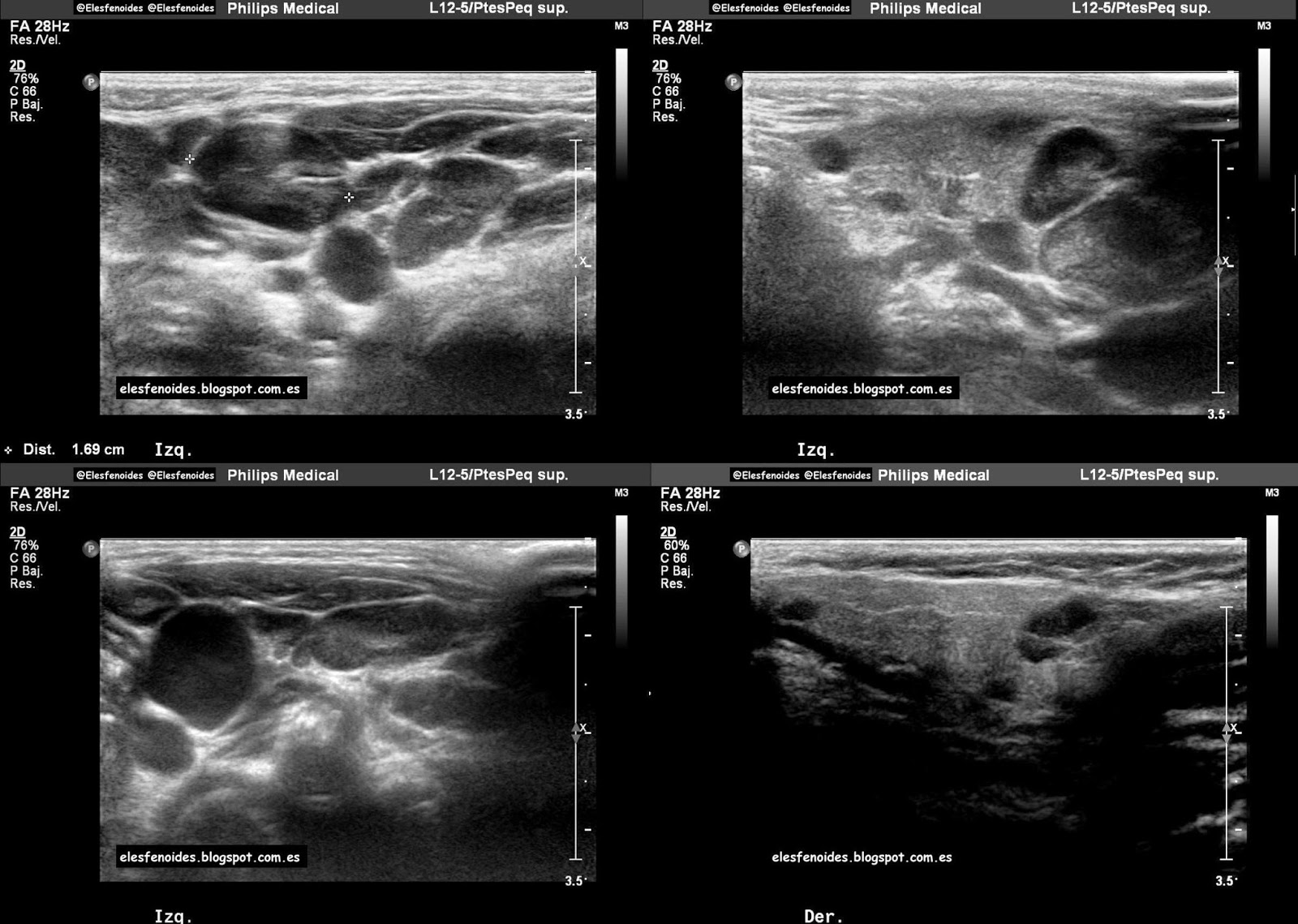 El esfenoides: Parotiditis aguda. 2 imágenes 1 caso.