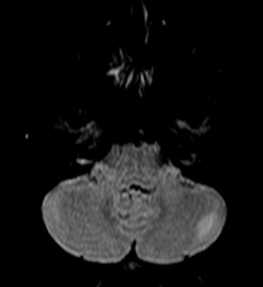 Paralisis de la mirada conjugada