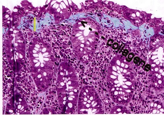 Colite colagenosa e colite linfocítica - Doença de Crohn e Colite ...