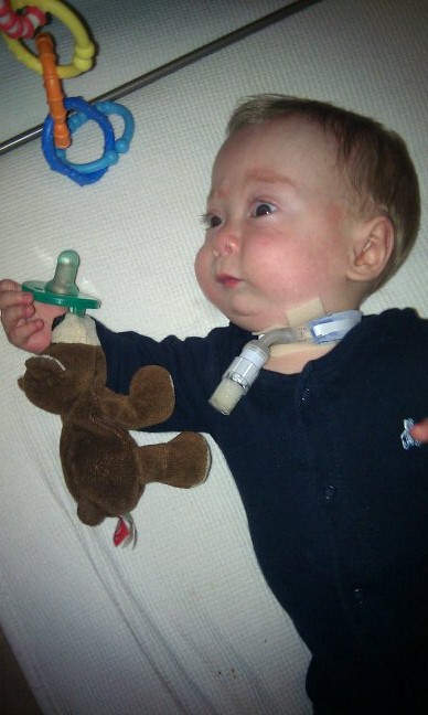 Bodie's Blog: Jaw Distraction Surgery