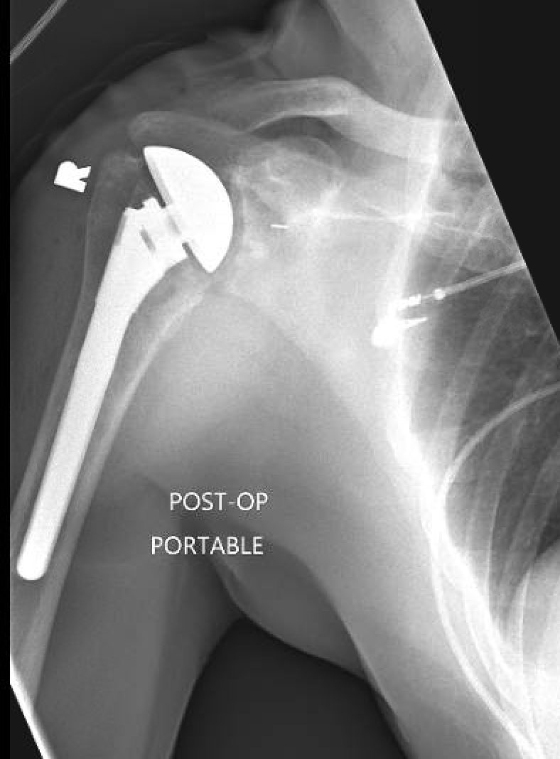 Shoulder and Elbow Surgery: The "moonlight" period of the shoulder ...