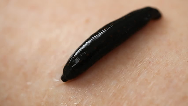 RAKTAMOSHAM OR LEECH THERAPY IN INDIA