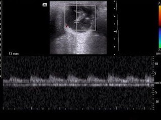 Persistent Hyperplastic Primary Vitreous : Case Report - Sumer's ...