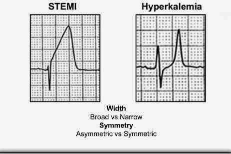 Enciclopédia de ECG - Nomenclatura: Onda T