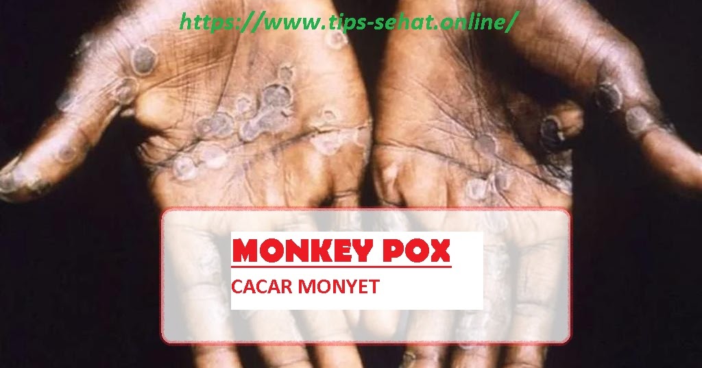 Kenali Penyebab,Gejala,penularan,Pengobatan Penyakit MonkeyPox (Cacar ...