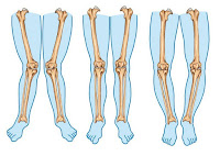 Belajar IPA: Macam macam kelainan atau penyakit tulang pada manusia ...