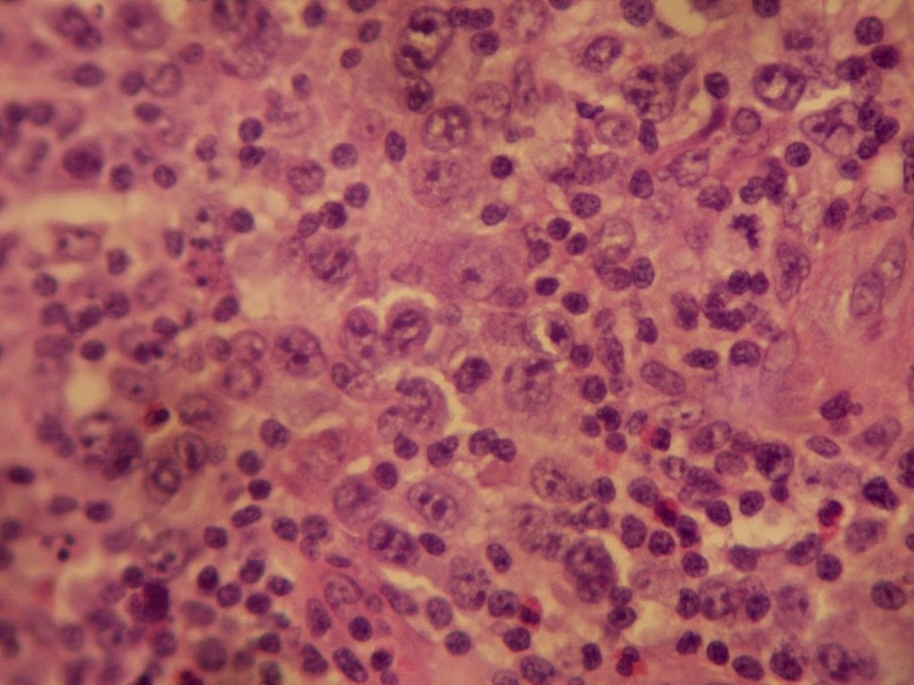 Células importantes en hematología: LINFOMA DE HODGKIN (CLASIFICACIÓN ...