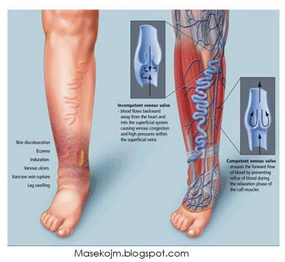 Cara Mudah Hilangkan Varises Dengan Tomat hijau - Bang Jo