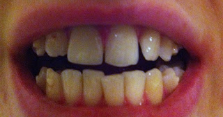 my invisalign: February 2012