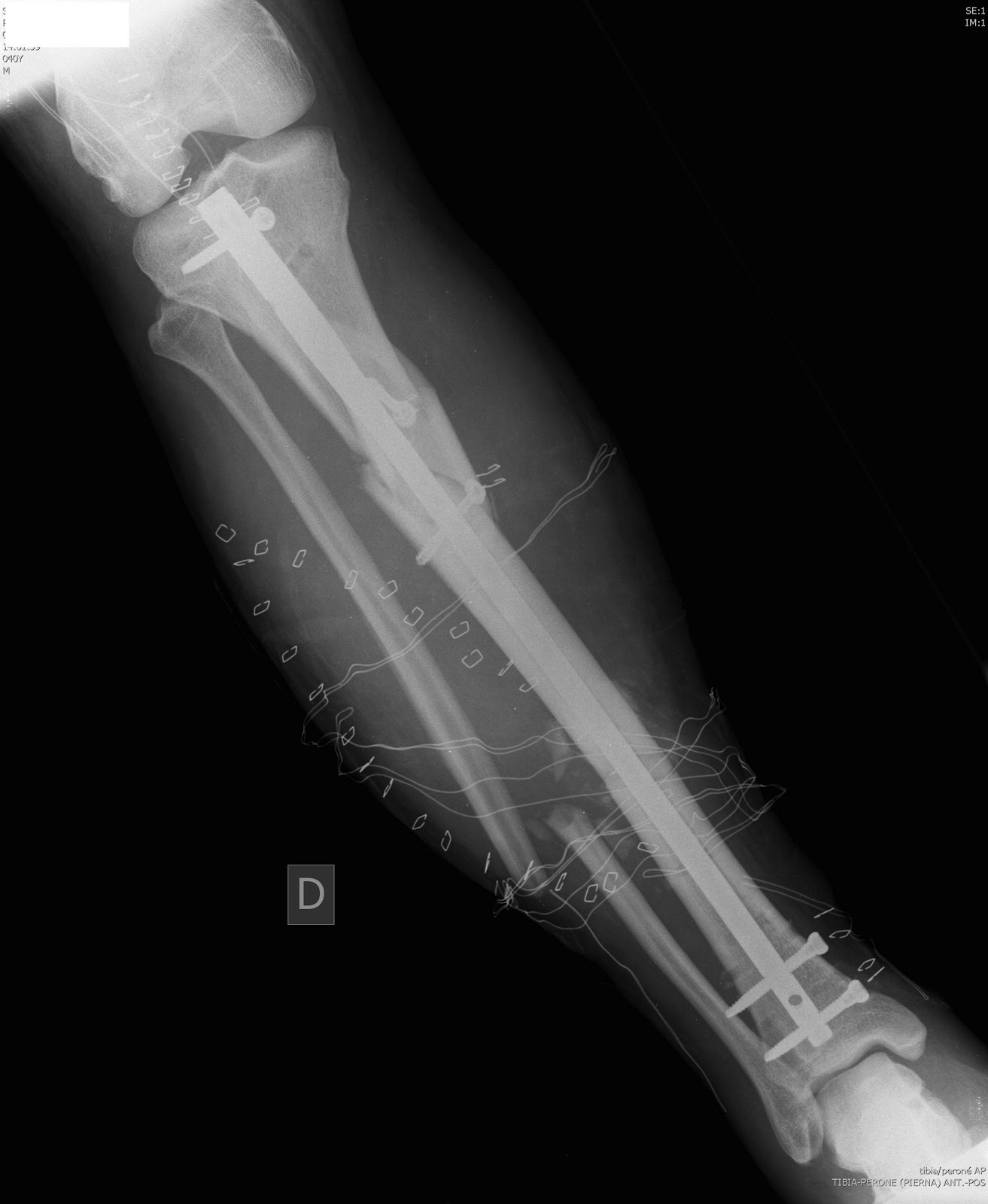 Salud Osteoarticular: LUXACION DE RODILLA