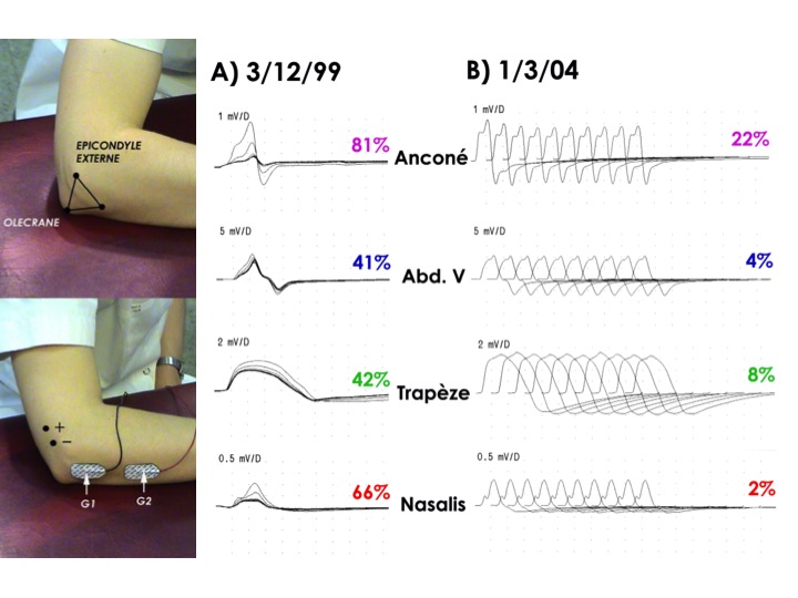Electroneuromyographie: Myasthénie