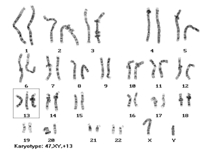 Patau Syndrome, Trisomi 13, Kelainan pada Kromosom 13 ~ Mrs. Binadari