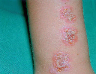 Fent Poble: Impétigo