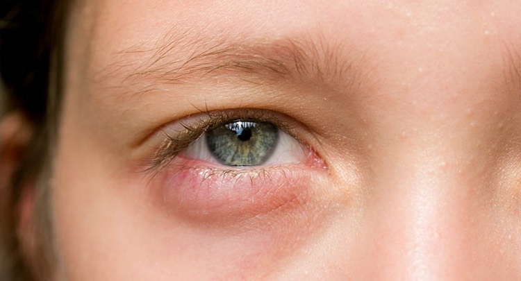 12 Cara Paling Efektif Mengatasi Mata Bisul Secara Alami - Cara Mengobati