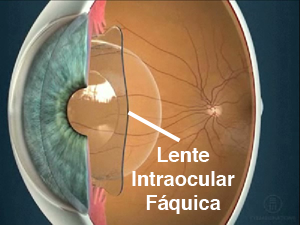 Cirugia intraocular