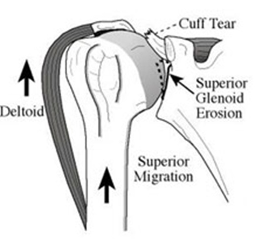 Indiaorthosurgeon: Cuff Tear Arthropathy