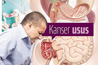info..info..info..: Kanser Usus