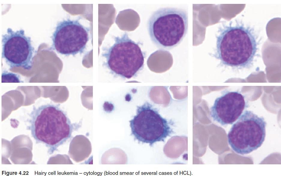 VETERINARY HEMATOLOGY DEXTERVET: hairy cell leukemia