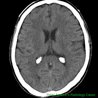 Dr Balaji Anvekar FRCR: Intracranial calcifications